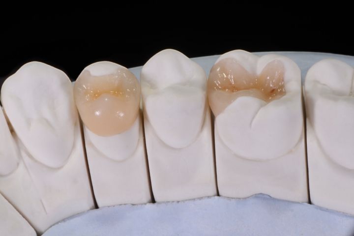 Ihr Zahnarzt für Teilkronen in Aachen | Dr. Georg Busche