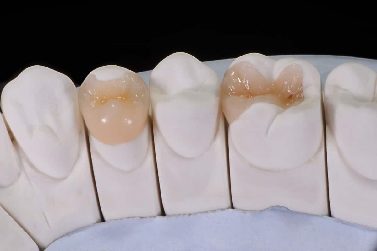 Ihr Zahnarzt für Teilkronen in Aachen | Dr. Georg Busche